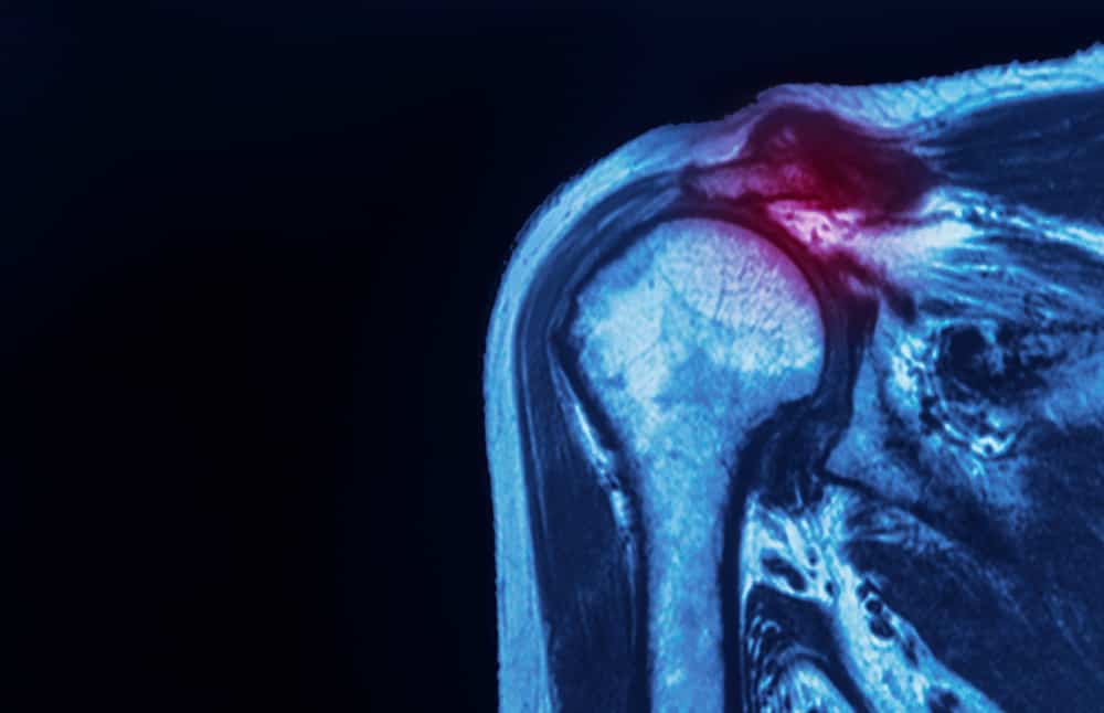 What s The Difference Between Acute And Chronic Rotator Cuff Tears 