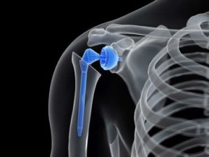 What You Need to Know About Shoulder Reconstruction Surgery ...